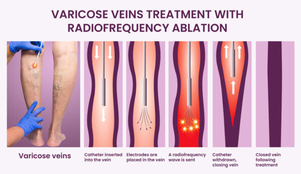 Radiofrequency Ablation - The Vein Institute of Hunterdon
