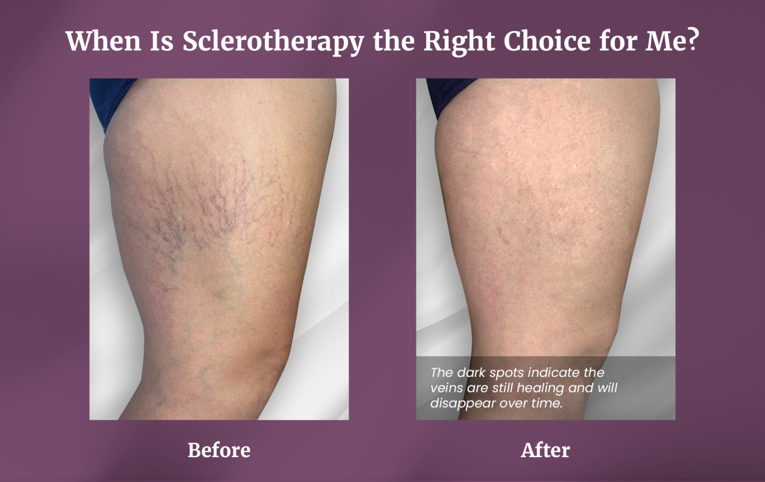 When Is Sclerotherapy the Right Choice for Me? - The Vein Institute of ...